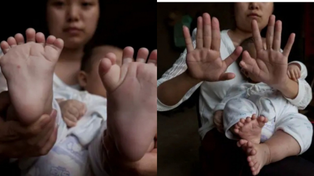 Infant born with extra 16 toes and 15 fingers which has surprised ...